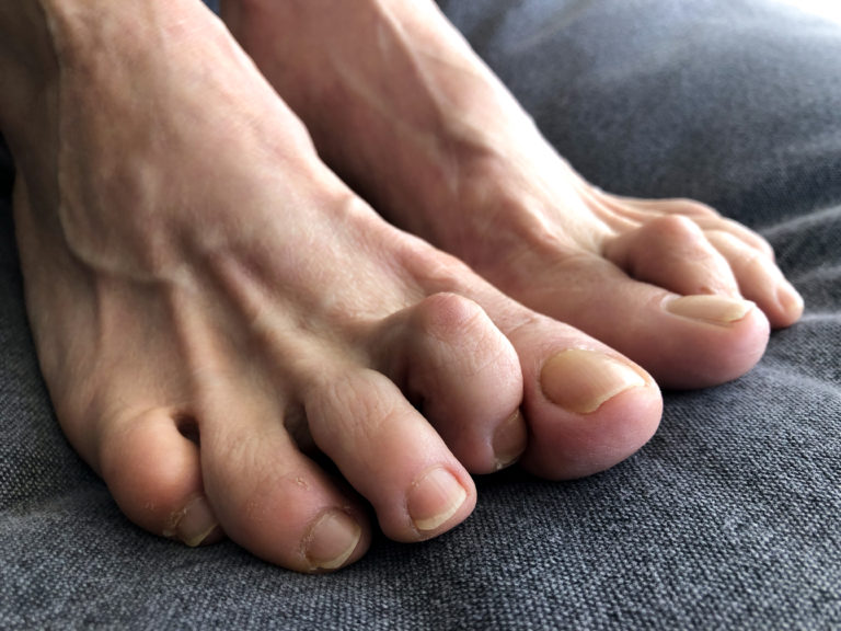 2nd Toe Capsulitis – Tom Biernacki
