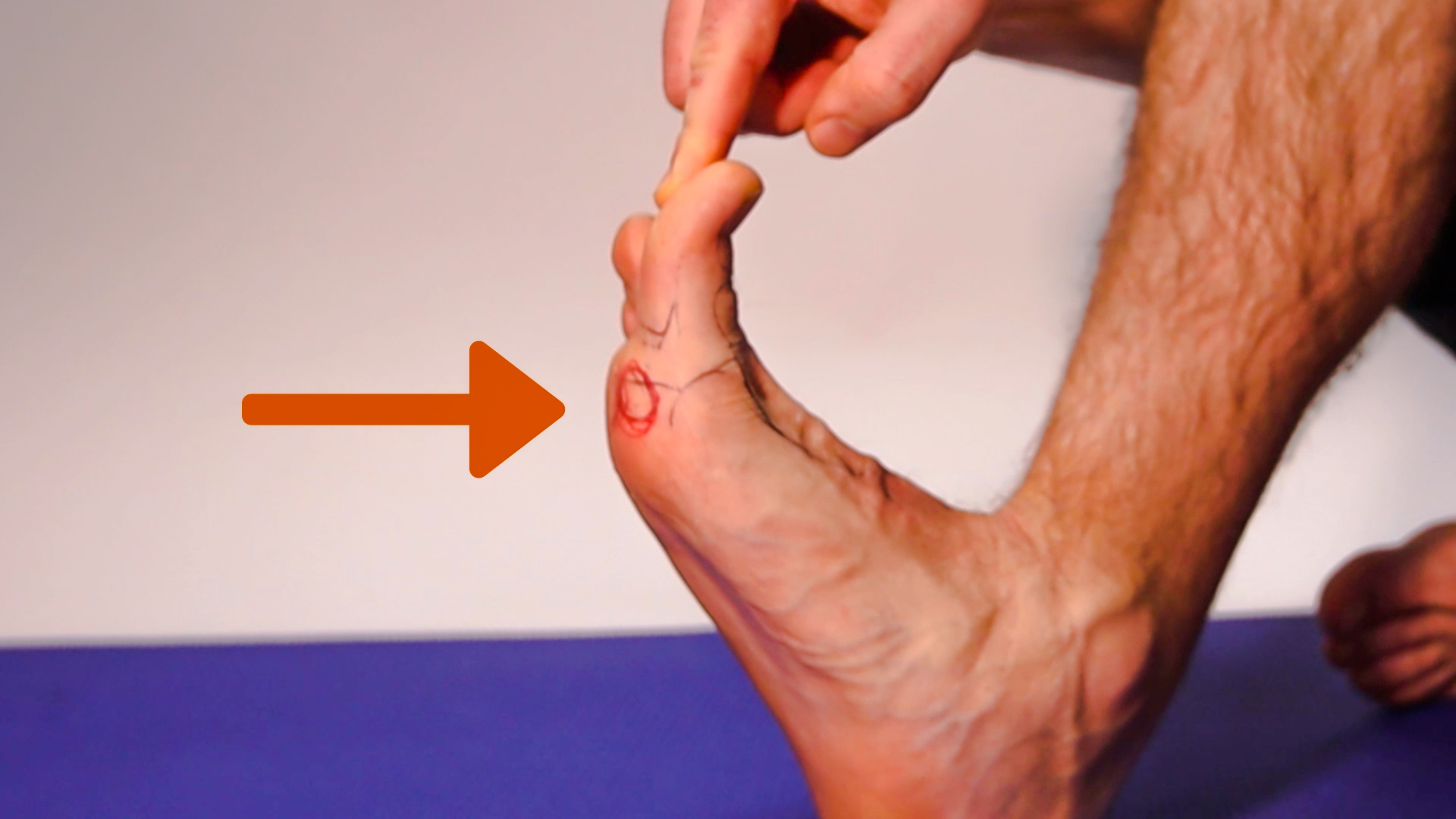 Sesamoiditis Taping Technique Best Sesamoiditis Home Treatment