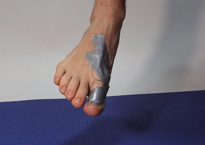 BEST Turf Toe HOME Treatment [Sprained Big Toe Treatment]